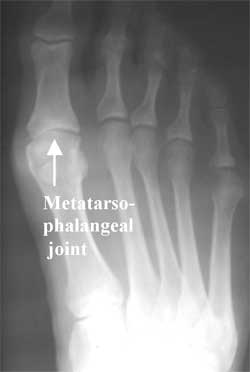 Structural Hallux Limits - San Diego Running & Sports Injury Clinic