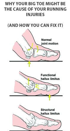 Structural Hallux Limits - San Diego Running & Sports Injury Clinic