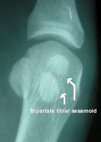What is Sesamoiditis? - San Diego Running & Sports Injury Clinic
